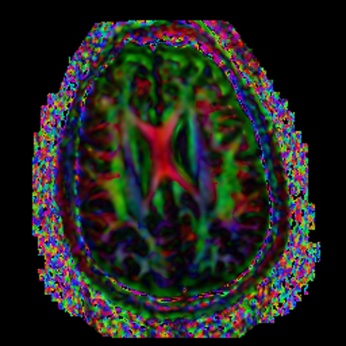 White Matter Development - AnalyzeDirect